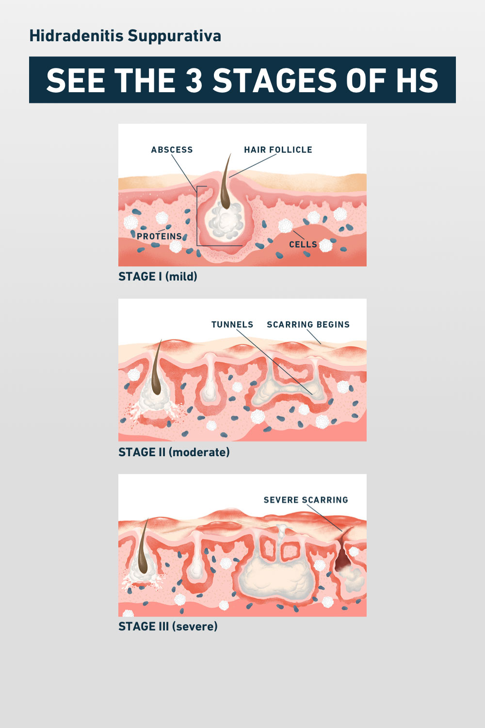 HS Symptoms Pictures No BS About HS